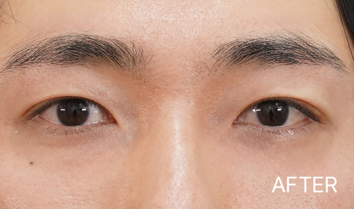 Eye Surgery for Men in Korea - Okay Plastic Surgery in Gangnam